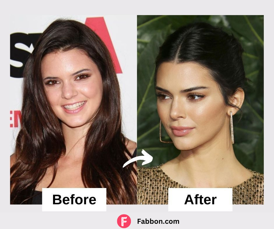 Revealed - Kendall Jenner Plastic Surgery Secrets (Before And After Photos) | Fabbon