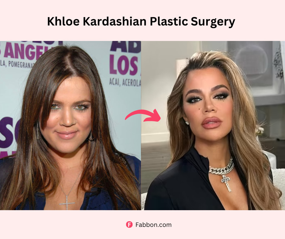 Khloe Kardashian Plastic Surgery Secrets - Revealed! | Fabbon
