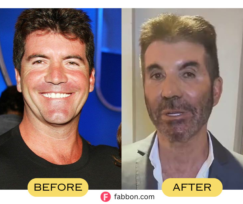 Revealed : 8 Cosmetic Procedures Simon Cowell Has Undergone As Per ...