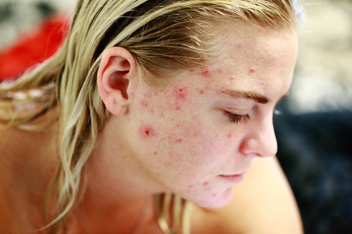 Acne Vulgaris: Types, Causes, Prevention And Treatment Guidelines | Fabbon