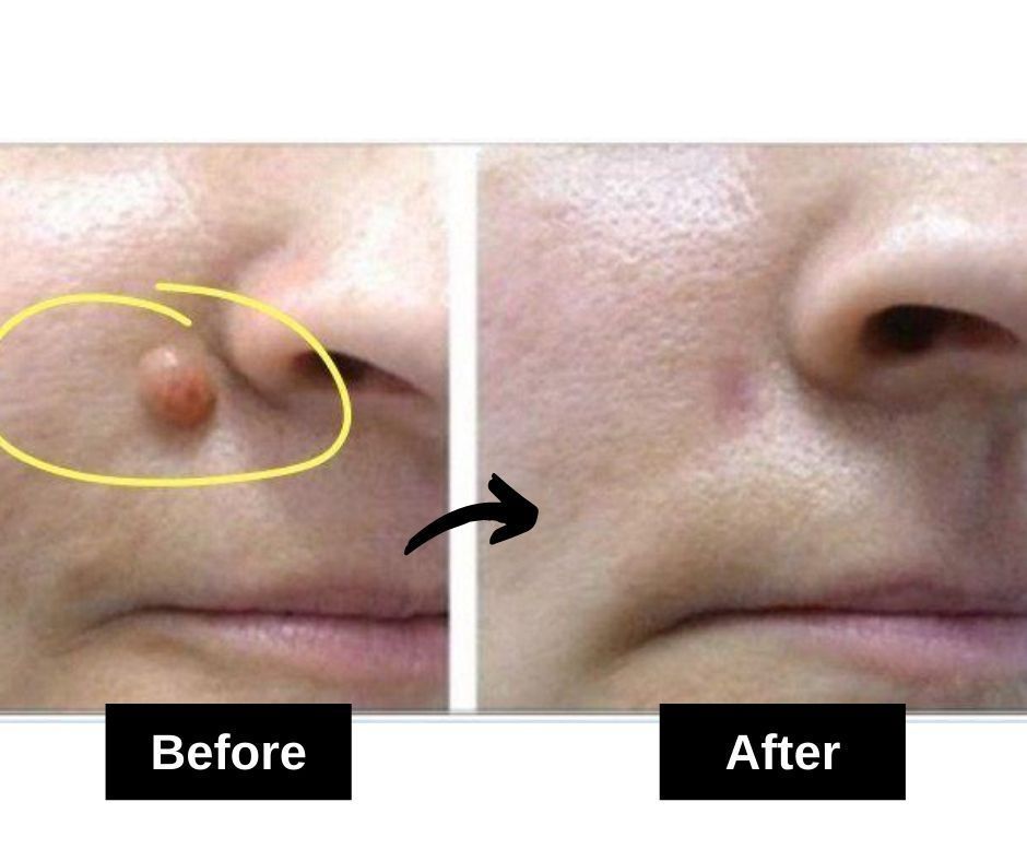 How To Remove Warts: 15 Most Effective Home Remedies | Fabbon