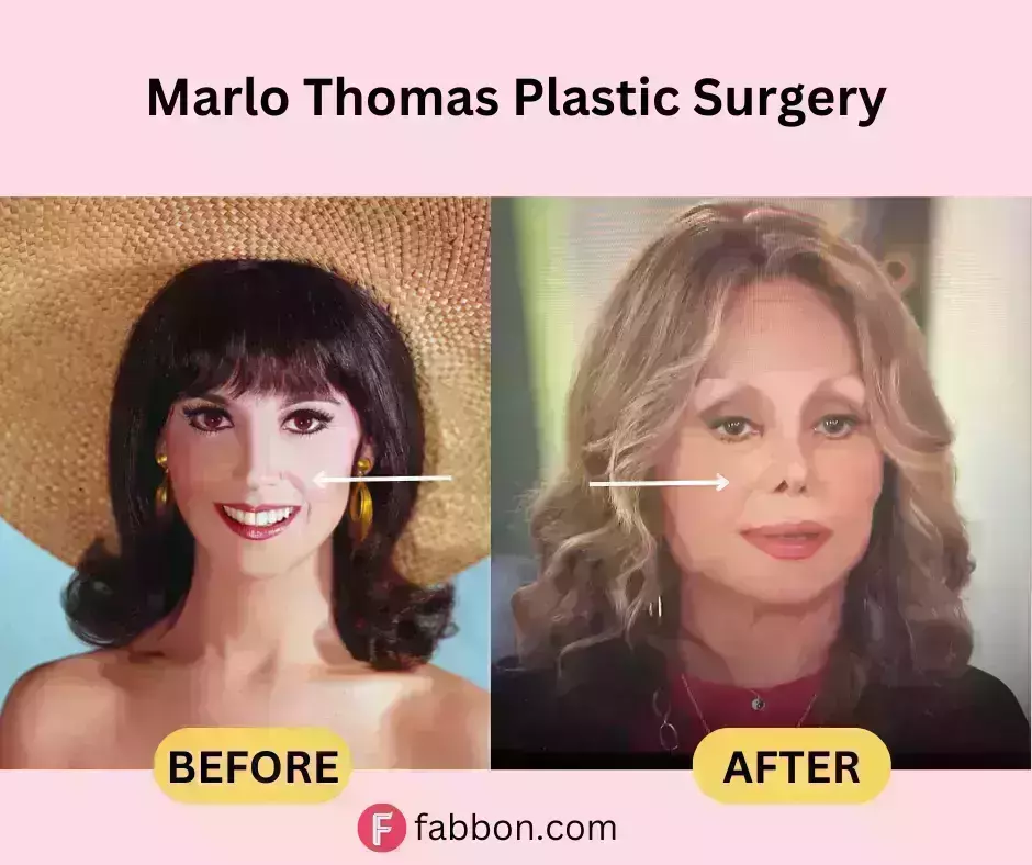 Marlo Thomas Plastic Surgery Secrets: Before And After Photos | Fabbon