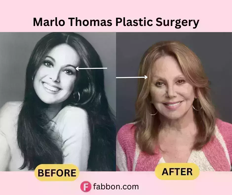 Marlo Thomas Plastic Surgery Secrets: Before And After Photos | Fabbon