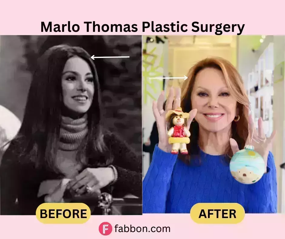 Marlo Thomas Plastic Surgery Secrets: Before And After Photos | Fabbon