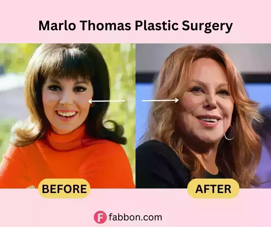 Marlo Thomas Plastic Surgery Secrets: Before And After Photos | Fabbon